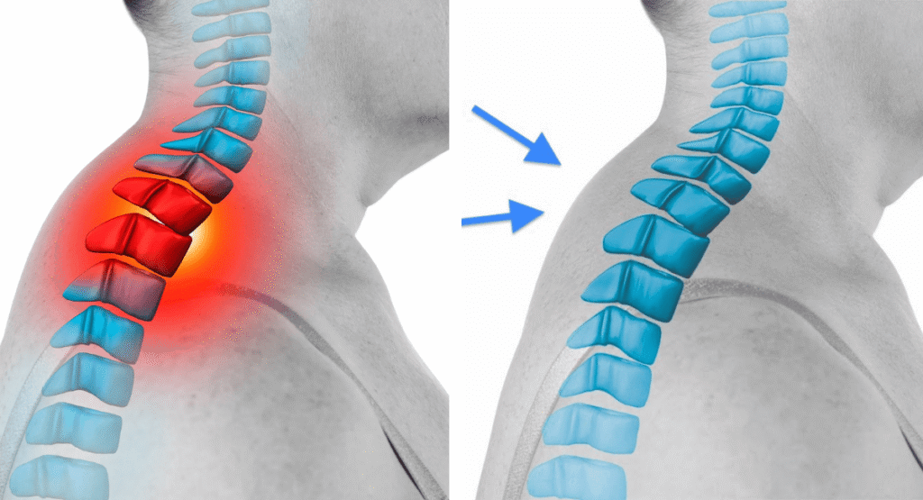 That Neck Hump on Your Back? It’s More Than Just Bad Posture